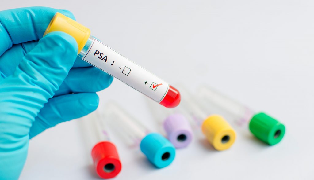 O que é a análise ao PSA e qual o seu valor diagnóstico?Na bexiga mando eu